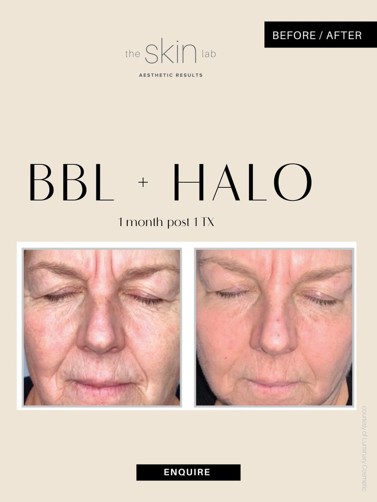 BBL + HALO: Before/After – The Skin Lab