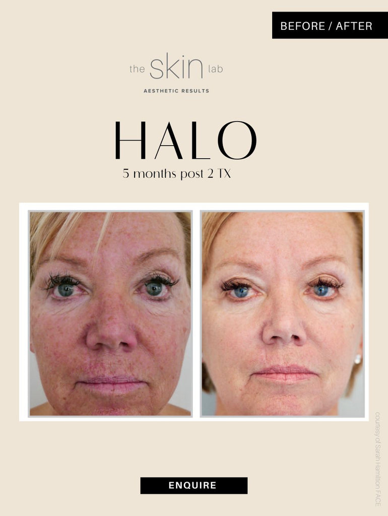 HALO: Before/After | Sciton HALO Laser Kerry – The Skin Lab