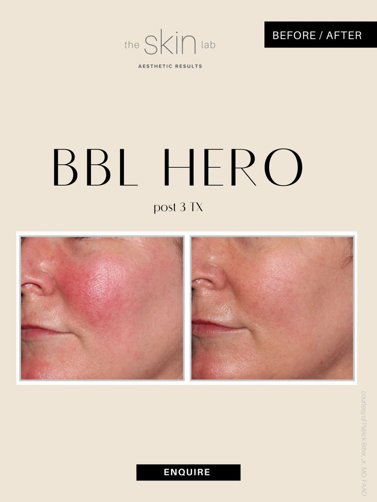 BBL HERO: Before/After | BBL HERO Treatment Kerry – The Skin Lab